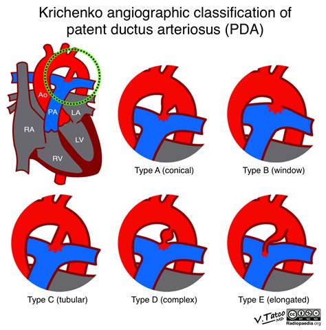 Krichenko Angiographic Classification Of Patent Ductus Arteriosus