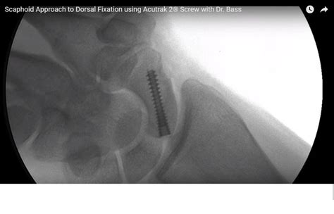 Dorsal Approach For Scaphoid Fracture Fixation Demo