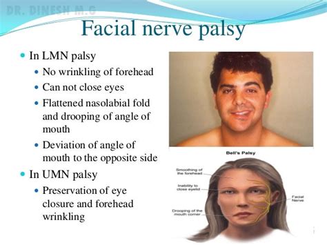 Unilateral Facial Nerve Paralysis
