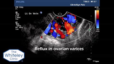 A Guide To Transvaginal Duplex Ultrasound As Performed At Whiteley