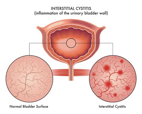 Cystite Interstitielle Causes Symptômes Et Traitements Esculape