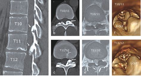 Figure 1 From Ossification Of The Ligamentum Flavum In The Thoracic