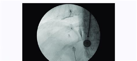 Intercostal Nerve Block Procedure