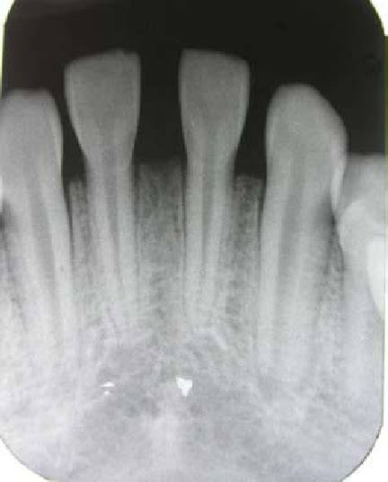 Periapical Radiograph Showing Absence Of Both Right And Left