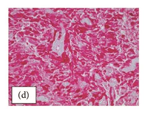 A Histologic Sections Showing A Cellular Proliferation Of Pleomorphic