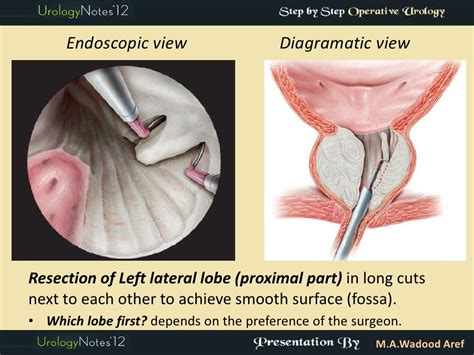 Turp Step By Step Operative Urology