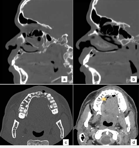 Frontal A B And Axial C Bone Window D Soft Tissue Window Ct Scan