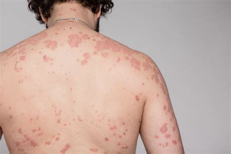 Symptom Itchy Skin Rashes