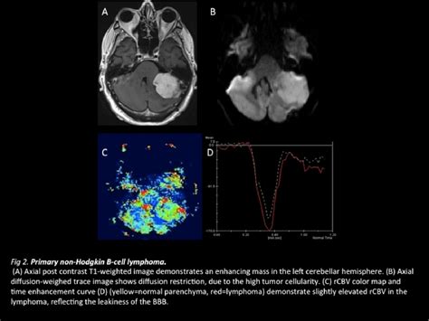 Figure 2 From Dynamic Susceptibility Contrast Enhanced Perfusion Mr