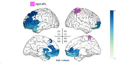 Seed Based Functional Connectivity Analysis Results For The Right