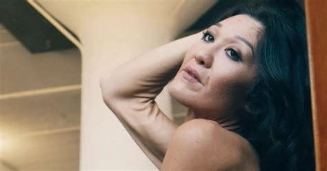 Brave 26 Year Old Woman With Rare Skin Condition That Makes Her Look