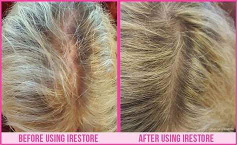 Tackling Hair Loss You Need The Irestore Laser Hair Growth System