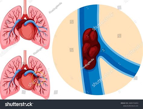 Human Anatomy Pulmonary Embolism Illustration Stock Vector Royalty