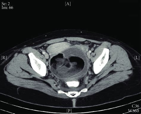 Computed Tomography Ct Scan Of The Pelvic Area Showing A 10 Cm × 9 5