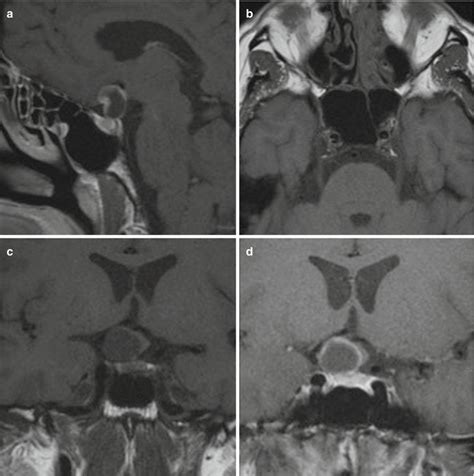 Cystic Craniopharyngiomas Endoscopic Endonasal Transsphenoidal