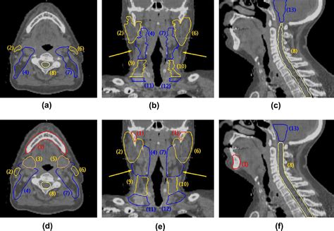 Atlas Based Delineation Of Lymph Node Levels In Head And Neck Computed