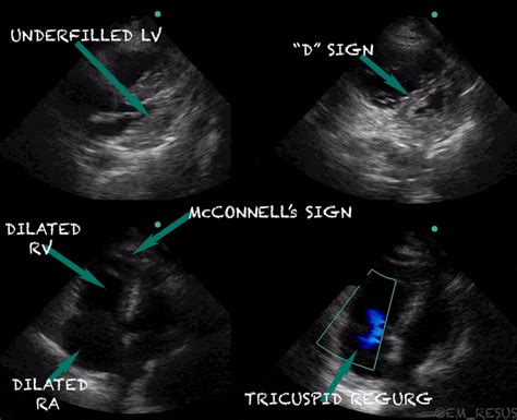 Pocus Echo Of Acute Massive Saddle Pulmonary Embolism Heres Grepmed