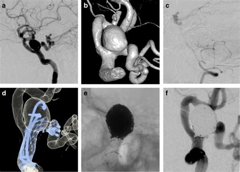 Cerebral Angiography And 3d Digital Subtraction Angiography Dsa Show