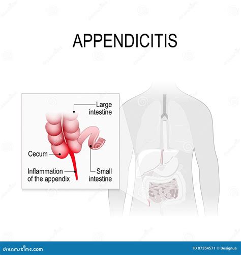 Appendicitis Location In The Human Digestive System Stock Vector