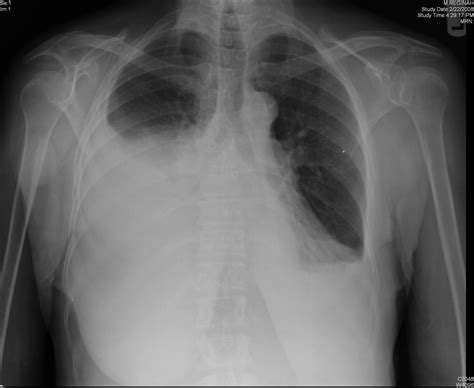 Pleural Effusion Vs Pneumothorax