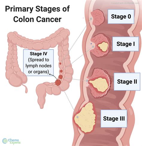 Colon Cancer Treatment Chemoexperts