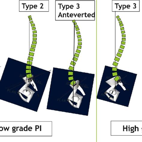 Classification Of The Normal Sagittal Alignment According To Roussouly