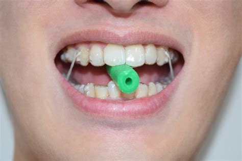How Do I Know If My Invisalign Clear Aligners Are Tracking