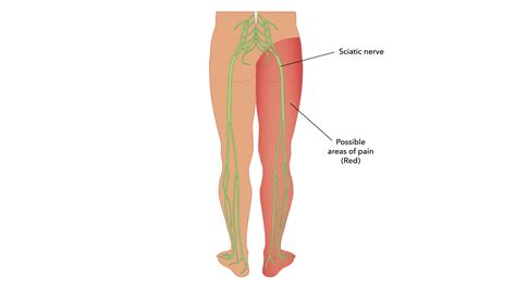 yoga and sciatica do s and don ts to consider