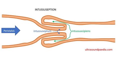 Intussusception Ultrasoundpaedia
