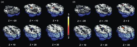 Brain Activation Patterns Showing Areas With A A Predominance Of