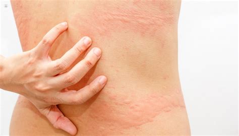 Urticaria Síntomas Y Tratamiento Para Este Padecimiento Top Doctors