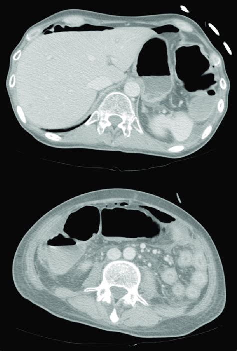 Computed Tomography Scan Showed Pneumoperitoneum Suggesting Bowel