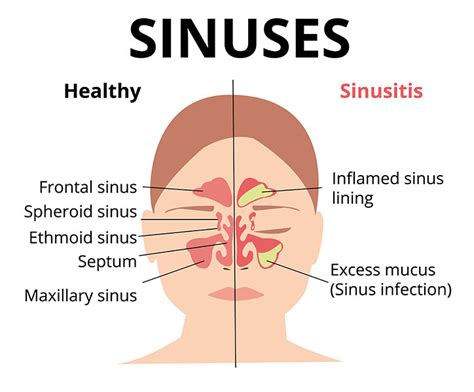 Chronic Sinusitis Symptoms Of Sinus Infection Sinus Treatment