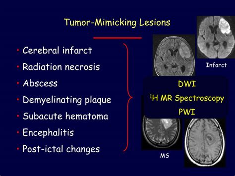 Ppt Adult Brain Tumors Powerpoint Presentation Free Download Id 287986