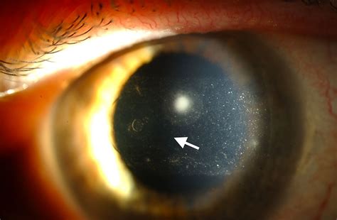 Corneal Inlay Implantation Complicated By Infectious Keratitis