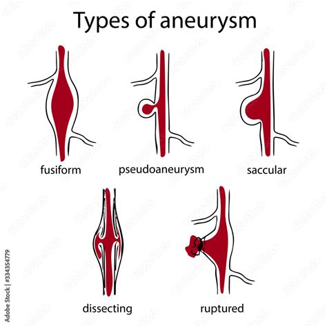 Stockvector Types Of Aneurysm Fusiform Pseudoaneurysm Saccular