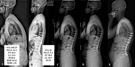 Modified Global Alignment And Proportion Scoring With Body Mass Index
