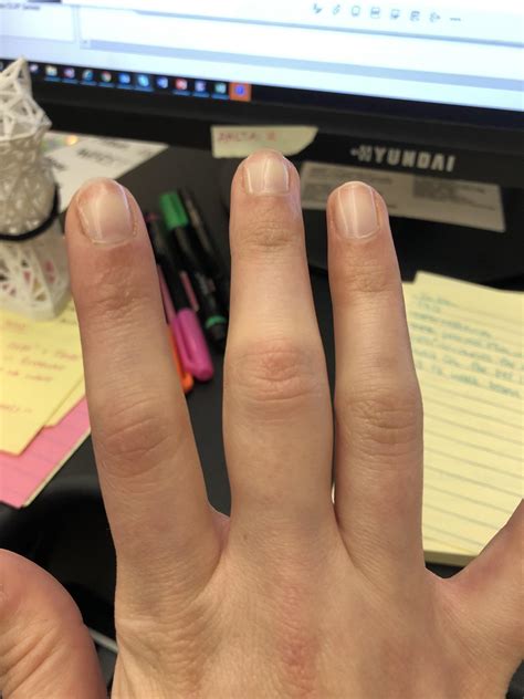 Recent Finger Swelling Middle Joint No Obvious Cause Ive Had Very