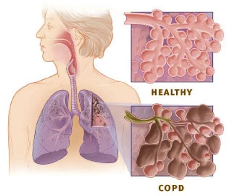 Spiroconnect Copd Medchip