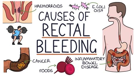 Understanding Rectal Bleeding Causes And Management