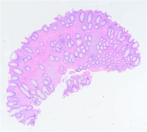 List 90 Pictures Pictures Of Cancerous Colon Polyps Updated