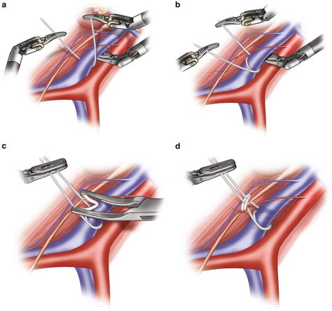 Robot Assisted Retroperitoneal Lymph Node Dissection Springerlink