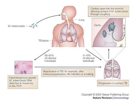 Tuberculosis 2 Pathophysiology And Microbiology Of Pulmonary Tuberculosis