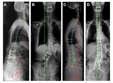 Preoperative A B And Postoperative C D Standing X Rays For