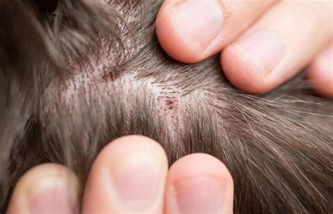 How To Treat Scabs On The Scalp