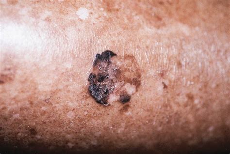 Squamous Cell Carcinoma Of The Legs In African Americans Journal Of