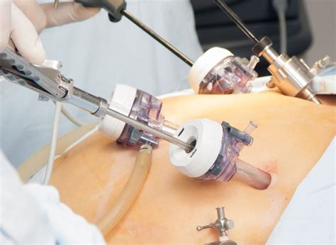 Laparoscopic Hysterectomy Yashadaa Hospital