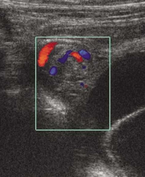 Gynecology Pelvic Ultrasound Made Easy Step By Step Guide Artofit
