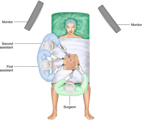 Sigmoid Colectomy Laparoscopic Technique Abdominal Key Hot Sex Picture
