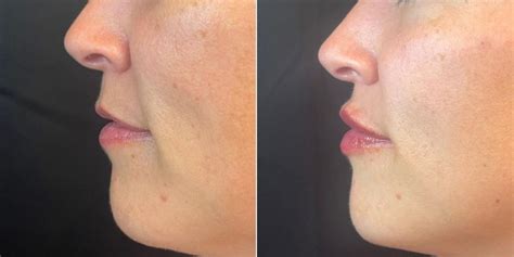 Dermal Fillers Before And After Pictures Case 24 Chico Yuba City